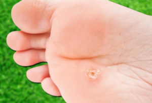 [:en]Treat Your Corns And Calluses With These Home Remedies[:] – Review ...